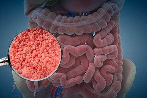 Pólipos intestinais - Coloproctologista em Porto Alegre, Dra. Fabiola ...